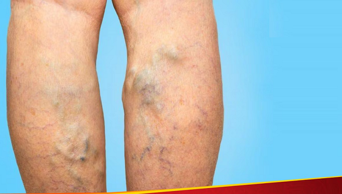 Why do blue, swollen and twisted veins appear in the legs? These people ...