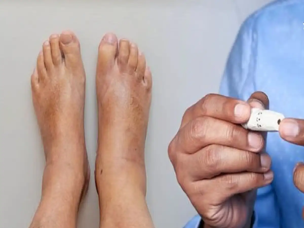 Diabetes Symptoms: These changes in the feet indicate diabetes; don't ...