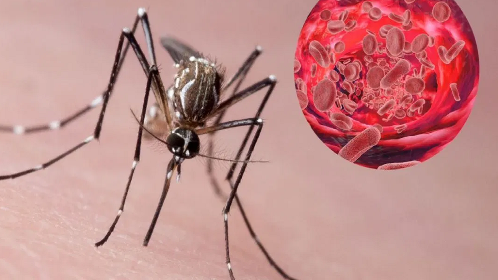 Recognizing Internal Bleeding in Dengue: Symptoms and Prevention Tips ...
