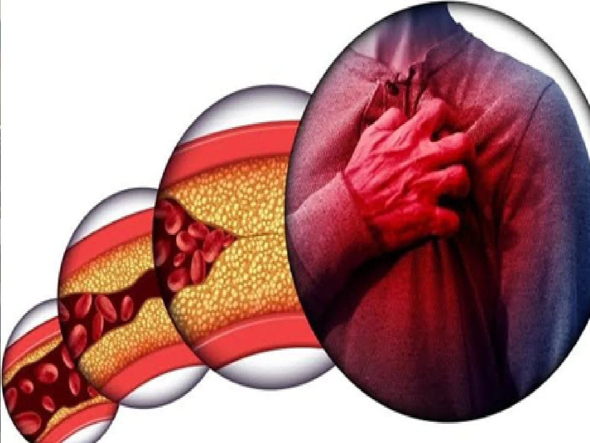 High cholesterol: 1 silent warning before a heart attack; never ignore ...