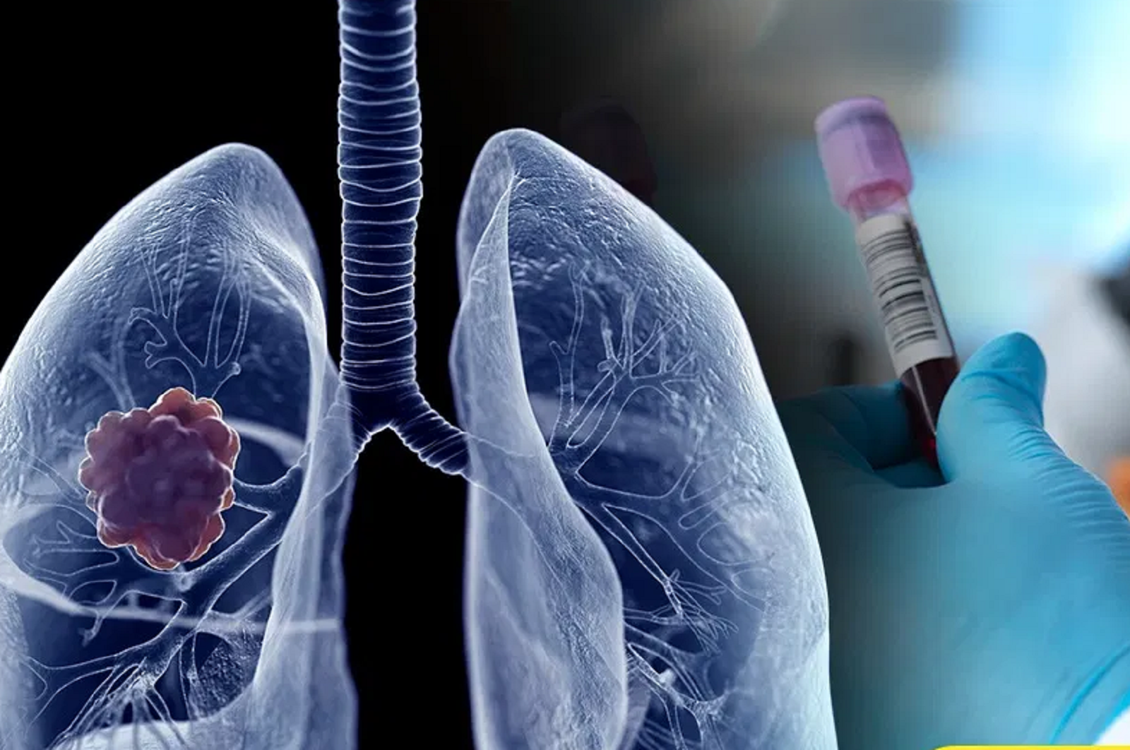 Lung cancer may now be detected through a blood test; new technique can ...