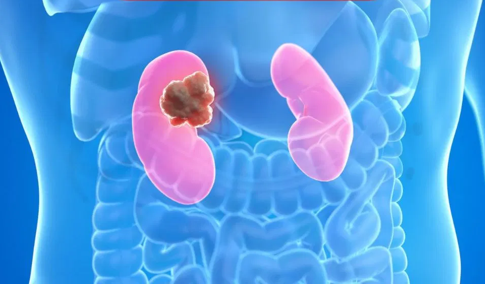 Kidney Stones: Not Just a Result of Poor Diet, Experts Highlight ...