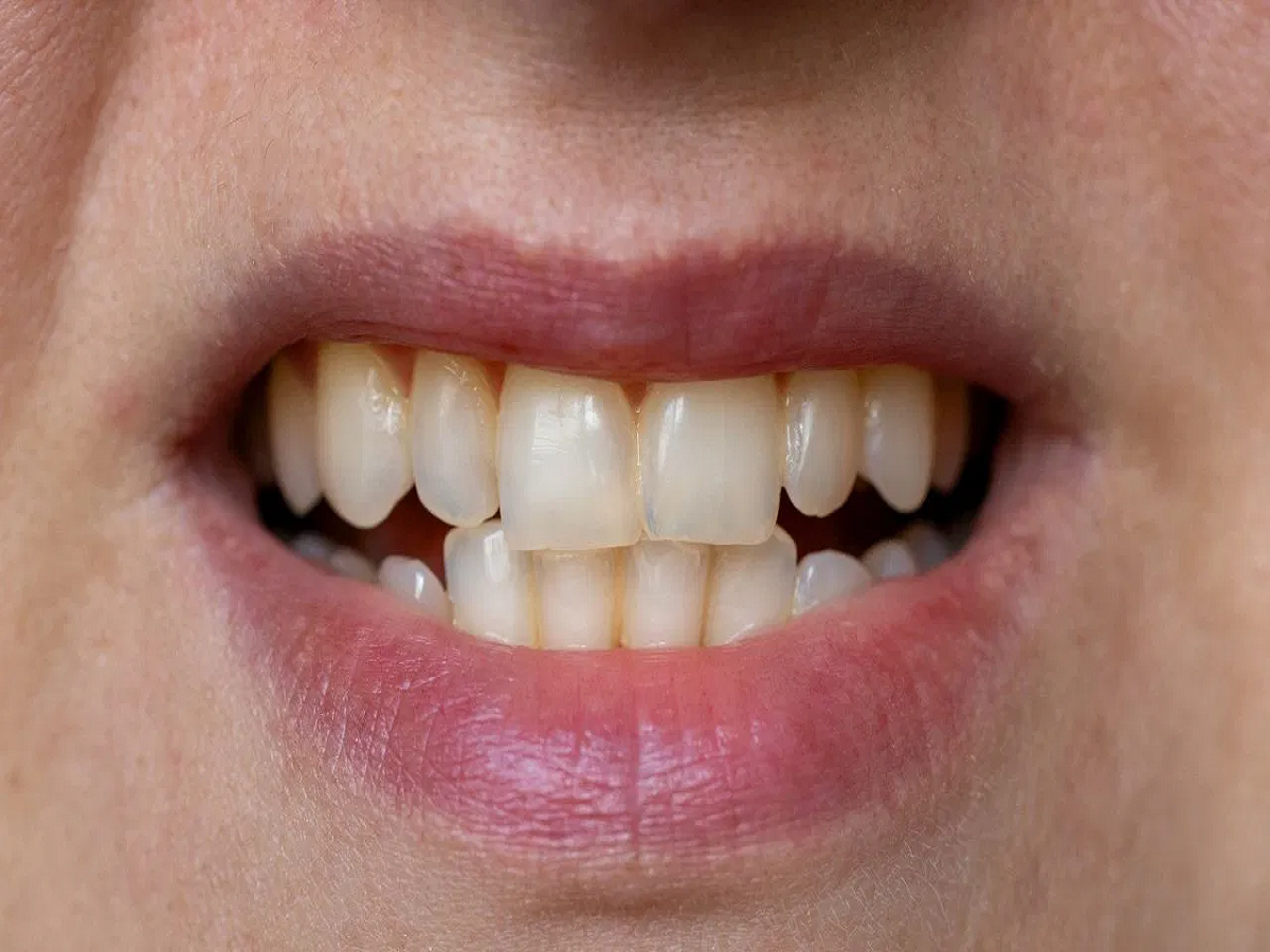 Why do teeth turn yellow even if you brush daily? Click here to know ...