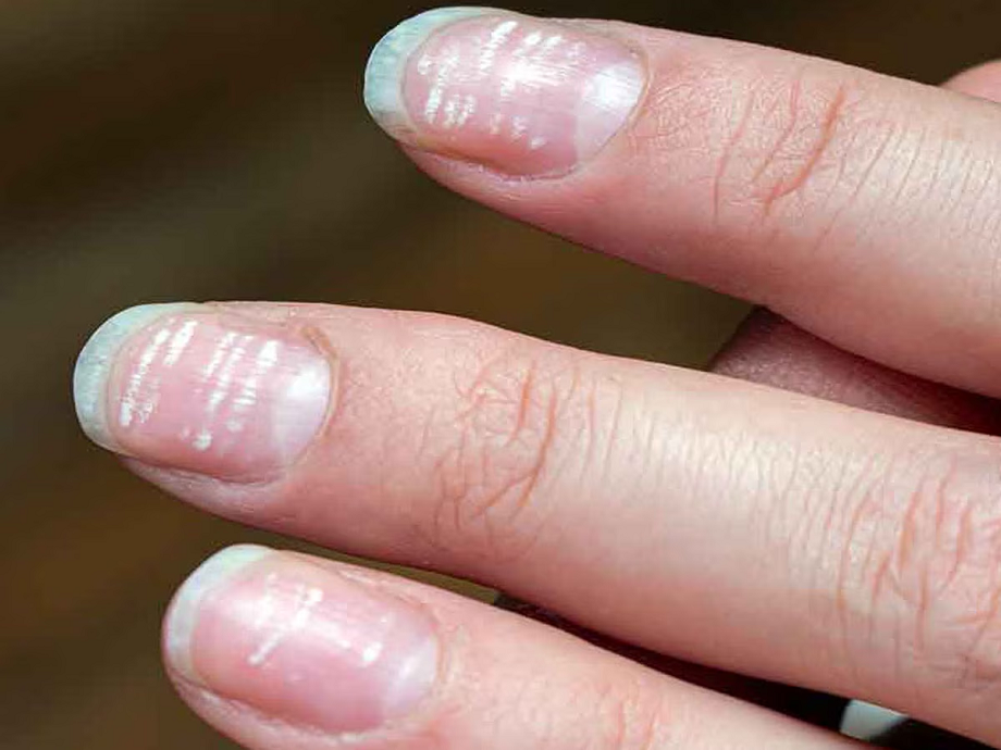 Nails will tell about the health of the liver, these 5 symptoms will ...