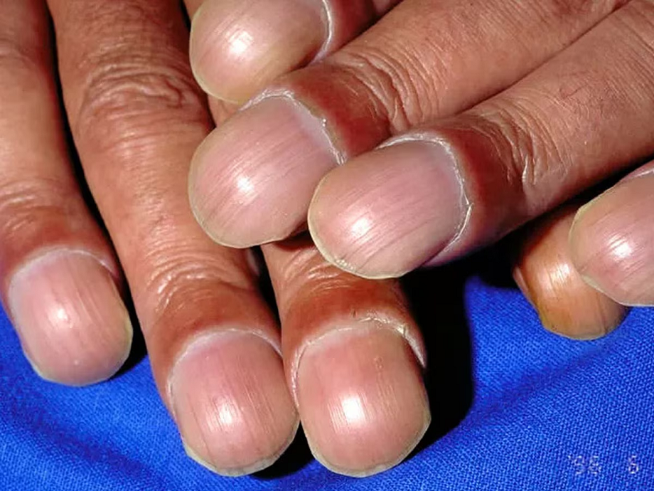 Nails will tell about the health of the liver, these 5 symptoms will ...